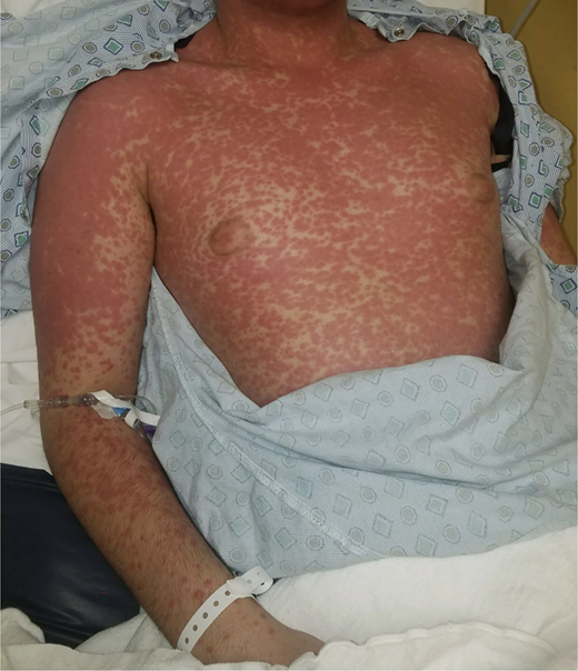 A Rash Decision | Pediatrics In Review | American Academy of Pediatrics